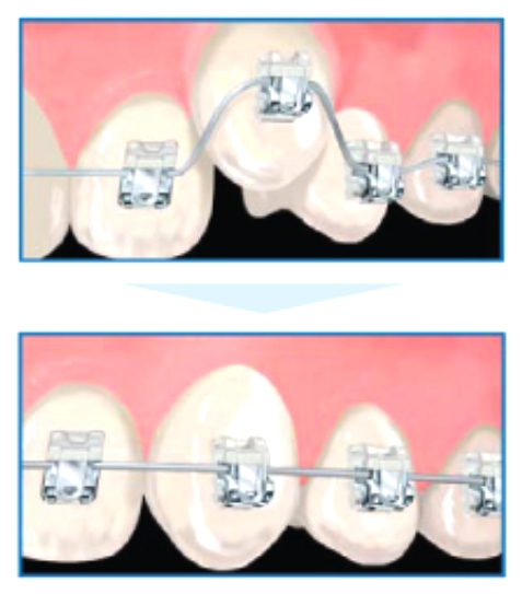 Damon Bracket: Damon Bracket
