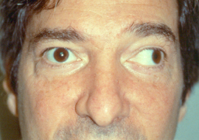 definition strabismus crossed eyes is a condition where the eye