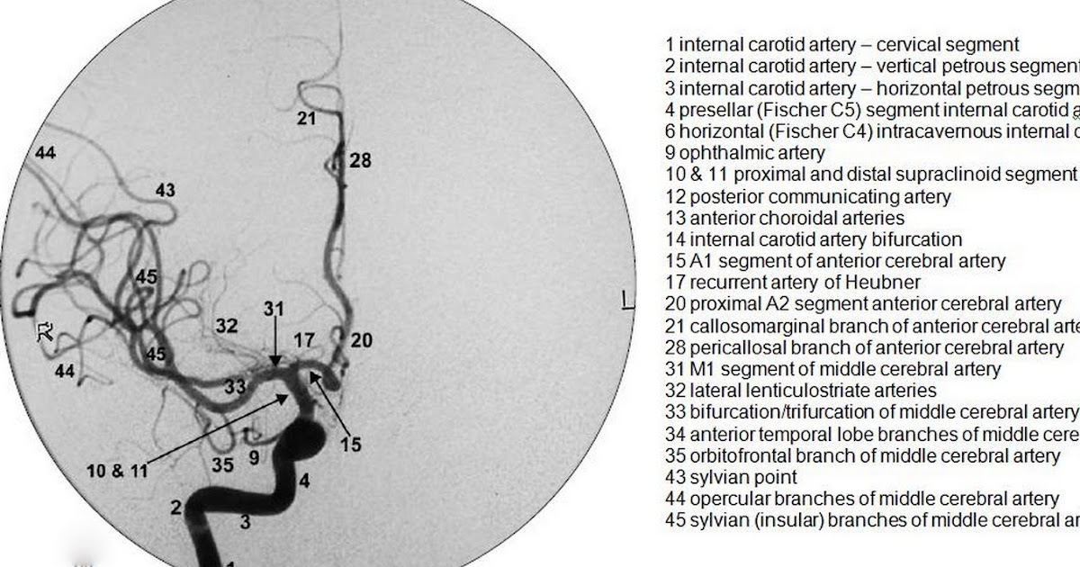 Neuroradiology Cases: Normal Brain Angiogram DSA