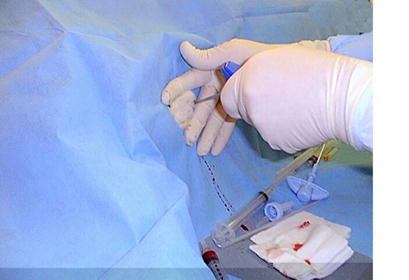 jm-s-adventure-with-multiple-myeloma-bone-marrow-aspiration-and-biopsy