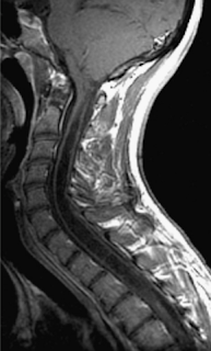 Chiari 1 Malformation-Mayo Radiology