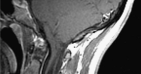 Chiari 1 Malformation-Mayo Radiology