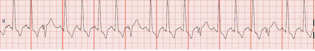 EKG Rhythm Strip Quiz 66