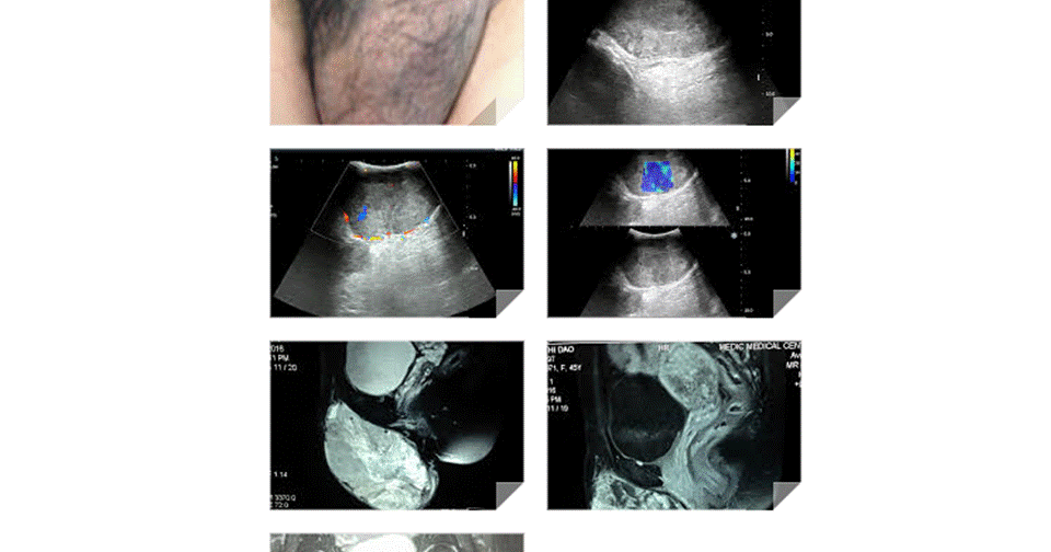VIETNAMESE MEDIC ULTRASOUND: CASE 395: MAJOR LABIA TUMOR, Dr PHAN THANH ...