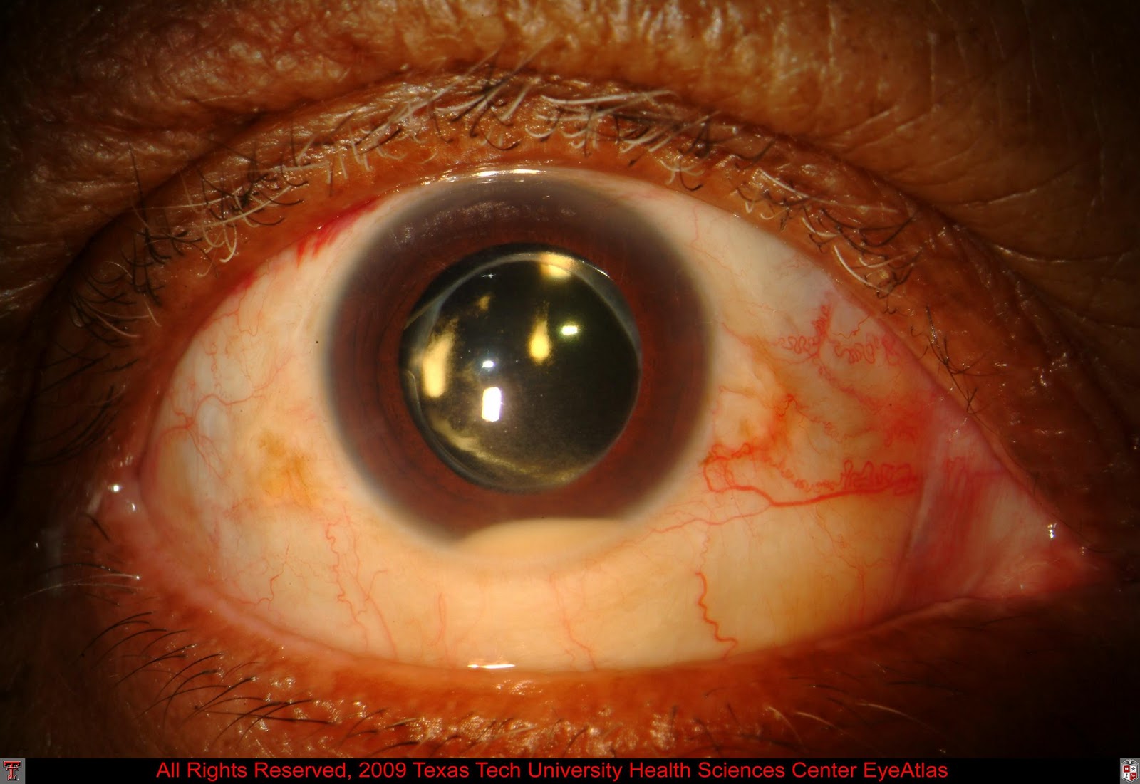 Photos For Red Eye With Hypopyon ~ YOUNG DOCTORS' RESEARCH FORUM