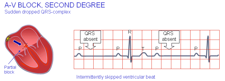 Second Degree AV Block | INA - ECG