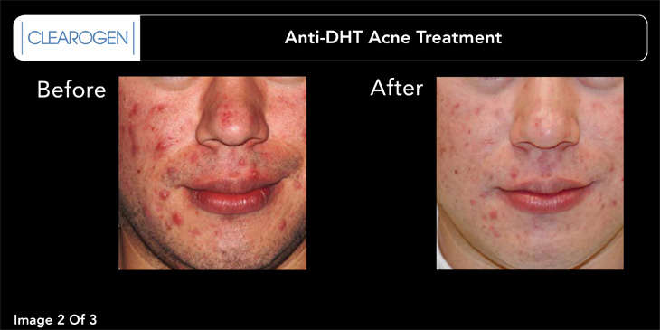 Clearogen: 3-Step Anti-DHT Acne Treatment