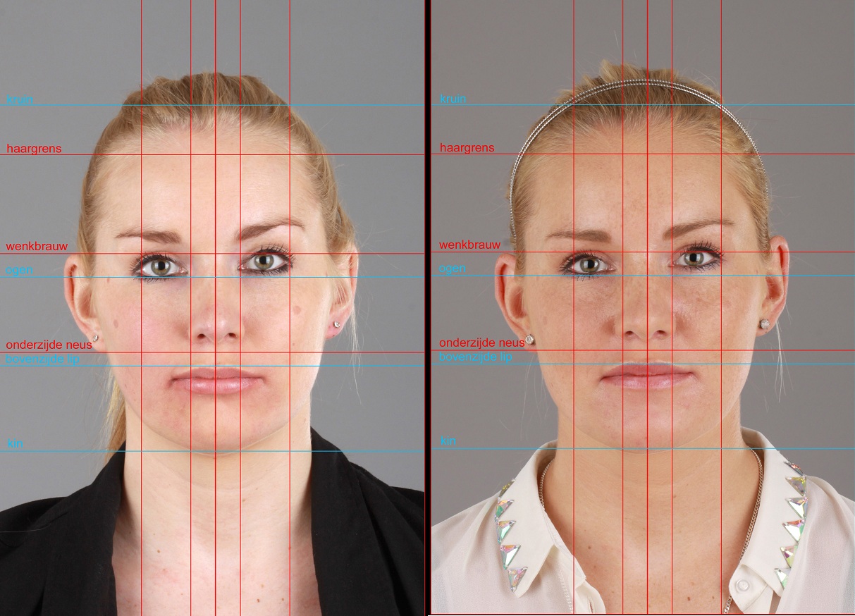 Cindy's kaakoperatie: VOOR- EN NA-FOTO'S KAAKOSTEOTOMIE