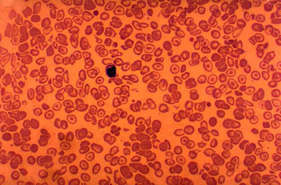 Beta thalassemia - target cells