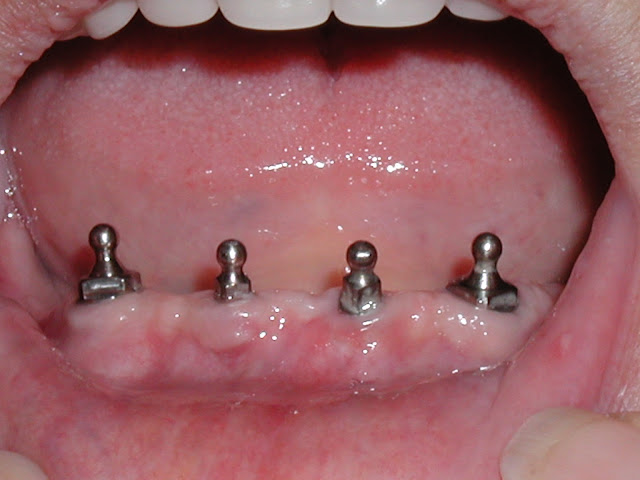 WHAT ARE MINI DENTAL IMPLANTS