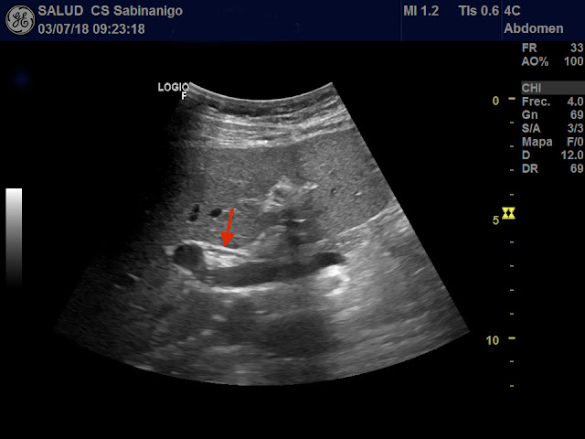 Ecografía en Atención Primaria: EL COLÉDOCO, cómo localizarlo