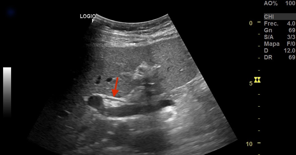 Ecografía en Atención Primaria: EL COLÉDOCO, cómo localizarlo