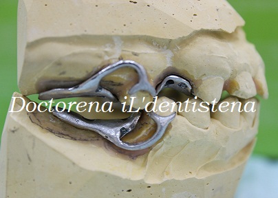 My Dental Diary: CO-Cr. RPD