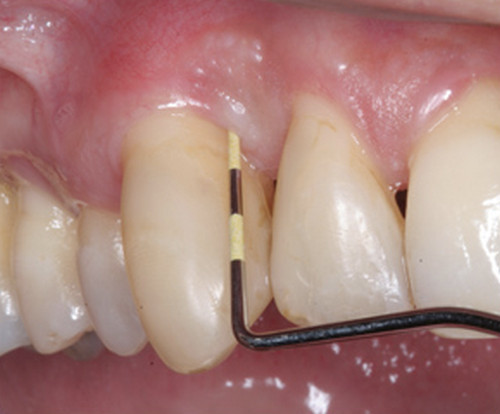 Gum Disease Pictures | Medical Pictures and Images - (2023 Updated)