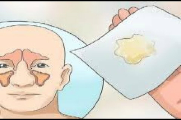 Remove The Root Sinusitis and Remove All The Mucus With This Method