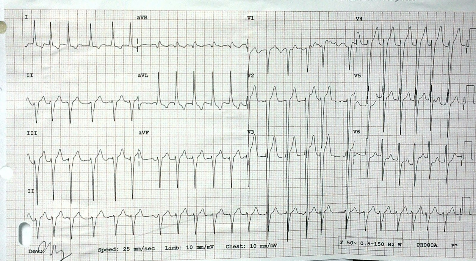 belajar membaca ekg: Atrial fibrilasi rapid ventriculer respon