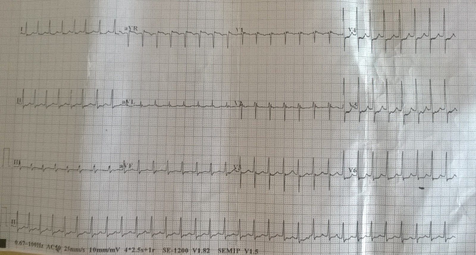 Cardiology window: PSVT