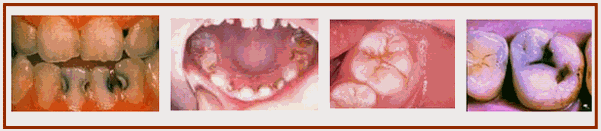 LA CARIES DENTAL: caries dental