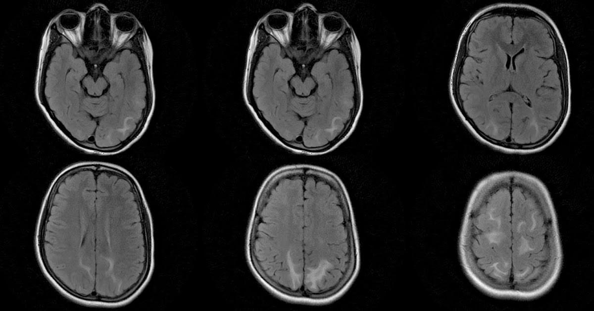 Neuroradiology Cases: Posterior Reversible Encephalopathy MRI