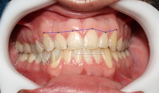 Correção da linha gengival a partir da técnica de gengivectomia em ...
