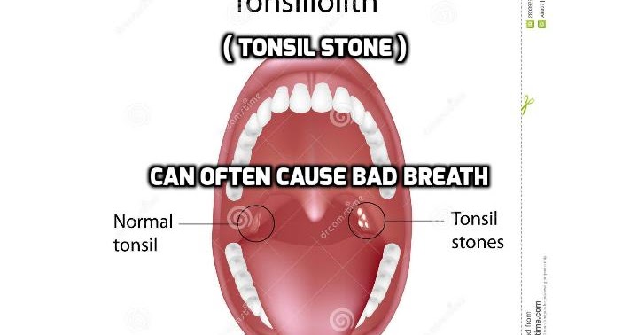 How To Have a Healthy Life: Tonsil Stones (Tonsilloliths) can often ...