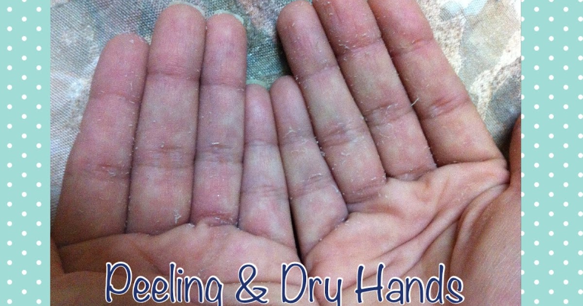 Home Remedies For Dry And Peeling Hands