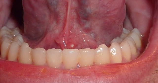 Understanding Your Normal under Tongue