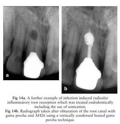 Endodontic: Internal inflammatory (infective) root resorption