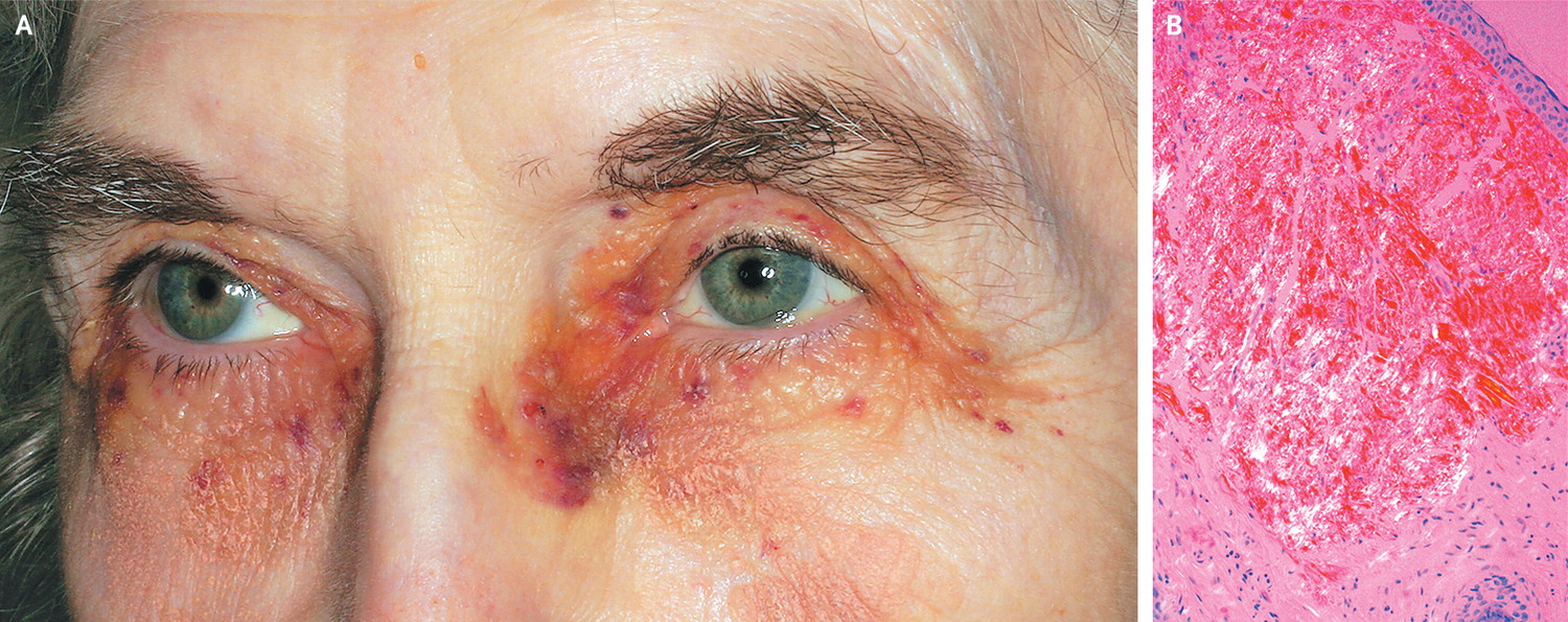 Dermatologic Signs of Multiple Myeloma