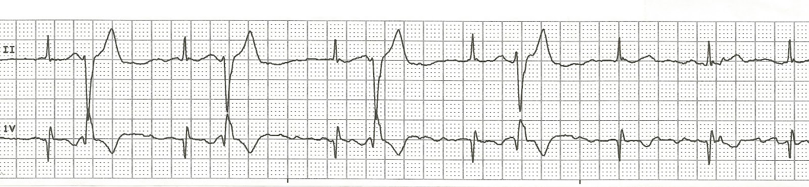 EKG Rhythm Strips 81: Bigeminy, Trigeminy, Quadrigeminy...