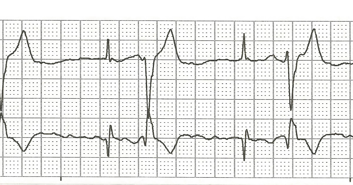 EKG Rhythm Strips 81: Bigeminy, Trigeminy, Quadrigeminy...