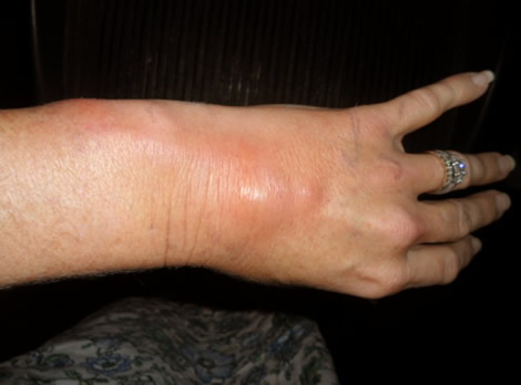About Health: Phlebitis