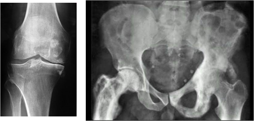 Dentistry and Medicine: Osteoarthritis