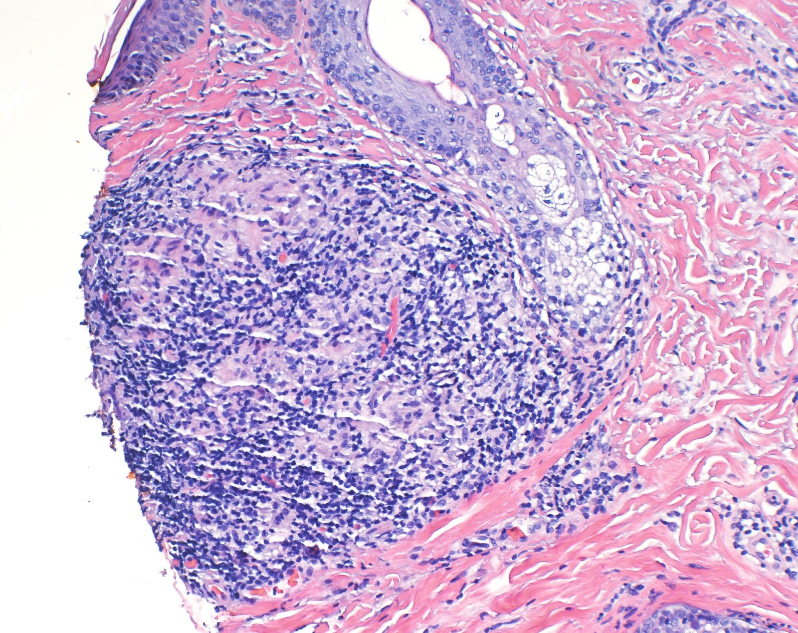Granulomatous Rosacea Histology