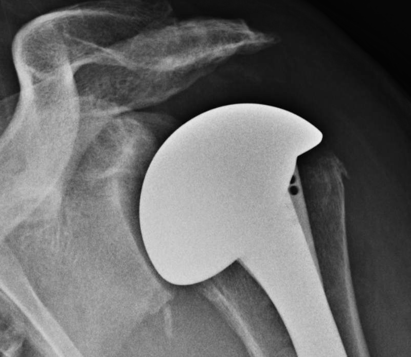 UW Shoulder and Elbow Academy: Shoulder arthritis and complete cuff ...