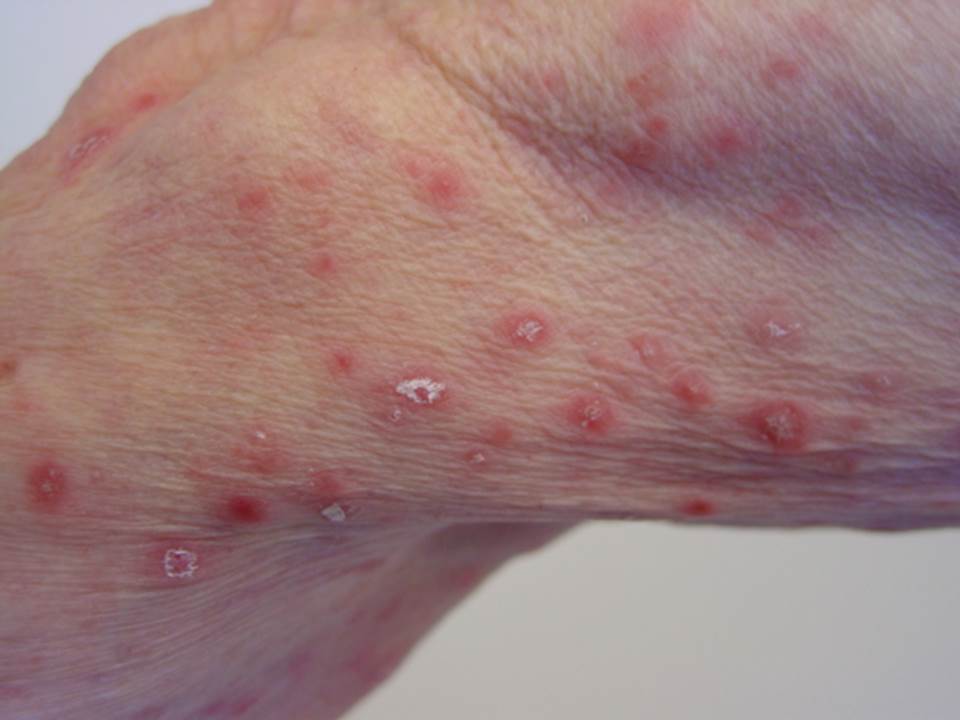 Teaching Dermatology Specialist Trainee Edition: Red Scaly Diseases