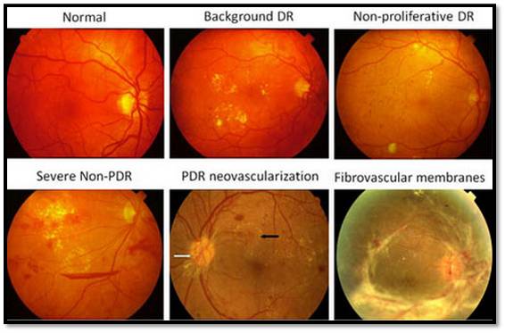PHARM. D IMPROVING HEALTH: different types of Diabetic Retinopathy