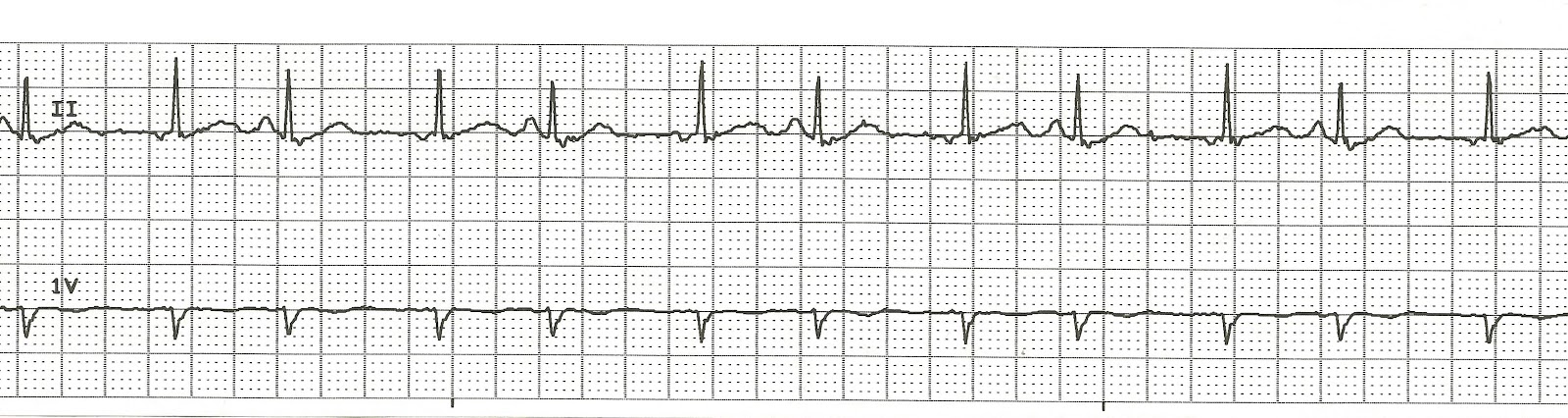 EKG Rhythm Strip Quiz 84