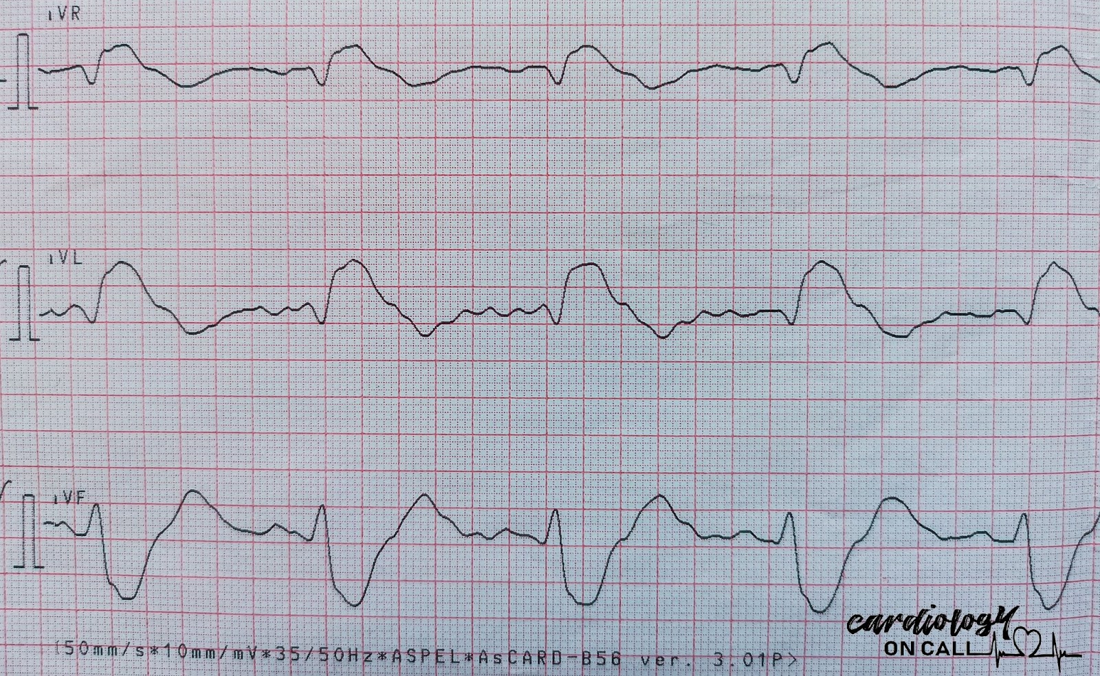 [CASE] 'Shark Fin' sign - true killer among ECG ischemic patterns