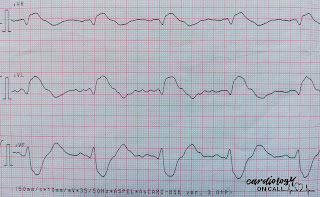 [CASE] 'Shark Fin' sign - true killer among ECG ischemic patterns