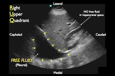 RUSH protocol: Rapid Ultrasound for Shock and Hypotension – MED-TAC ...