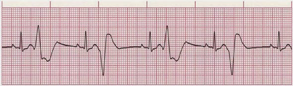 CONTOH GAMBARAN EKG ABNORMAL