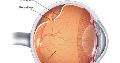 Retinal Ablation Is - America Health Information