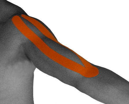 ARES Kinesiology Tape: Arestape Applications - Biceps