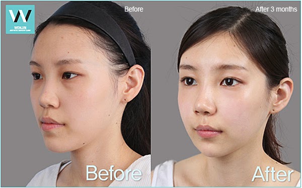 Facial Asymmetry Correction Before And After