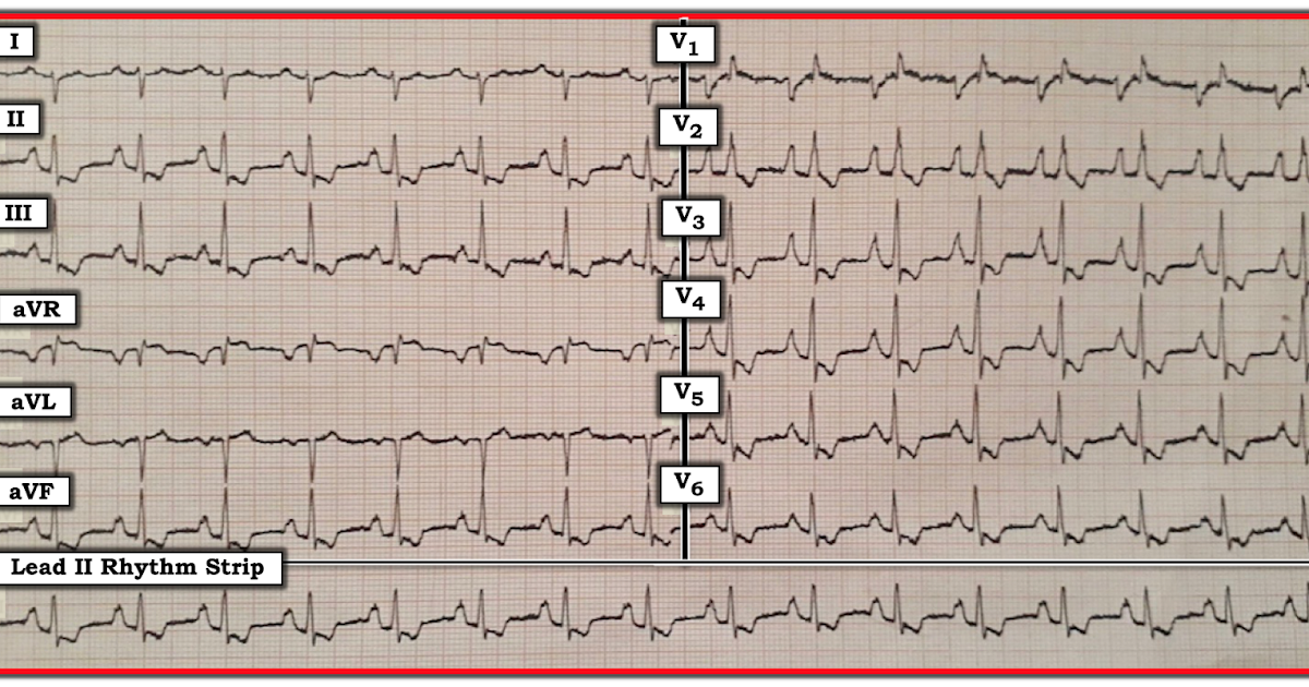ECG Interpretation: ECG Blog #156 (LVH – RVH – LAA – RAA – Strain ...
