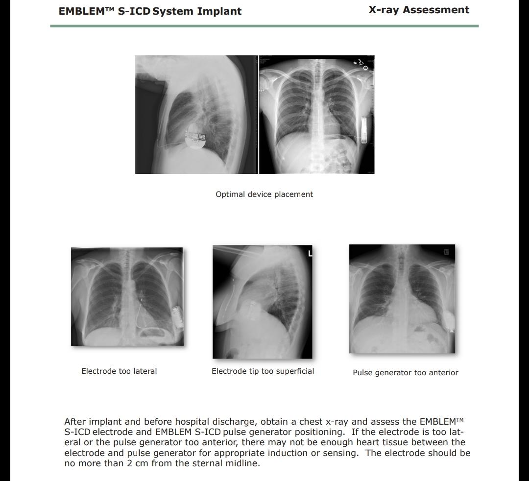 CVT Mohd Farid: Implant Management Of Subcutaneous ICD Boston Emblem SICD