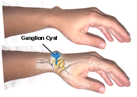 Cara Mengobati Ganglion Secara Alami Tanpa Operasi