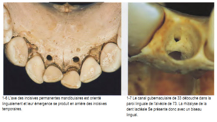 Le Traitement orthodontique et chirurgical des dents incluse: des dents ...