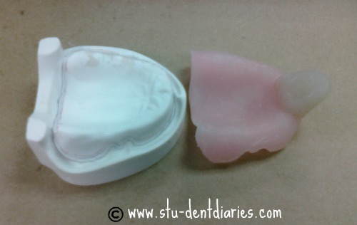 Stu-DENT Diaries: Custom Tray, Record Base and Wax Rim